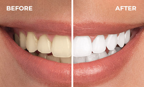 Miracle Smile™ - Revolutionary 360° Water Flosser Effectively Cleans ...